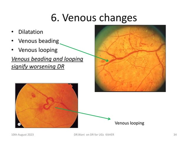 DR VIVEK WANI TALK ON DIABETIC RETINOPATHY FOR KLE MBBS STUDENTS UG ...