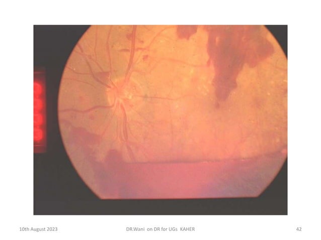 DR VIVEK WANI TALK ON DIABETIC RETINOPATHY FOR KLE MBBS STUDENTS UG ...