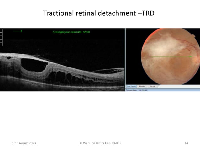 DR VIVEK WANI TALK ON DIABETIC RETINOPATHY FOR KLE MBBS STUDENTS UG ...
