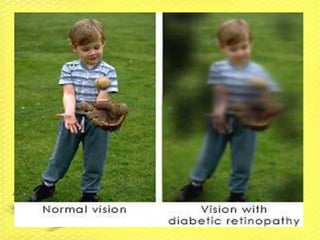 Diabetic retinopathy group 7 period 2 # | PPT