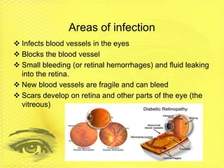 Diabetic retinopathy group 7 period 2 # | PPTX