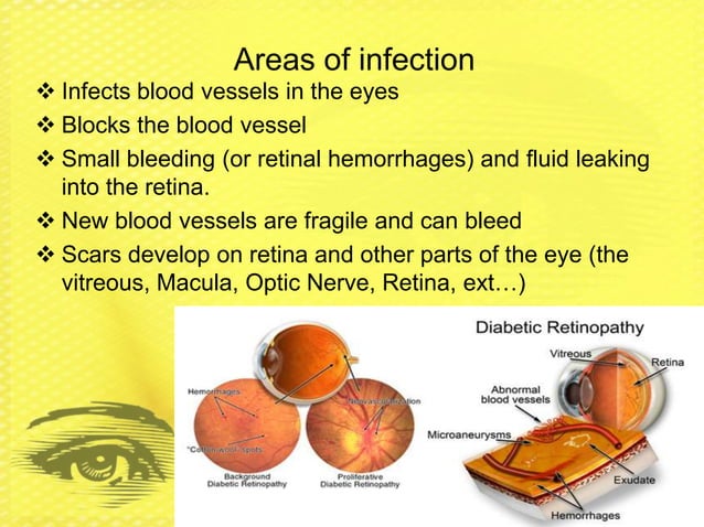Diabetic retinopathy group 7 period 2 new 4 | PPT