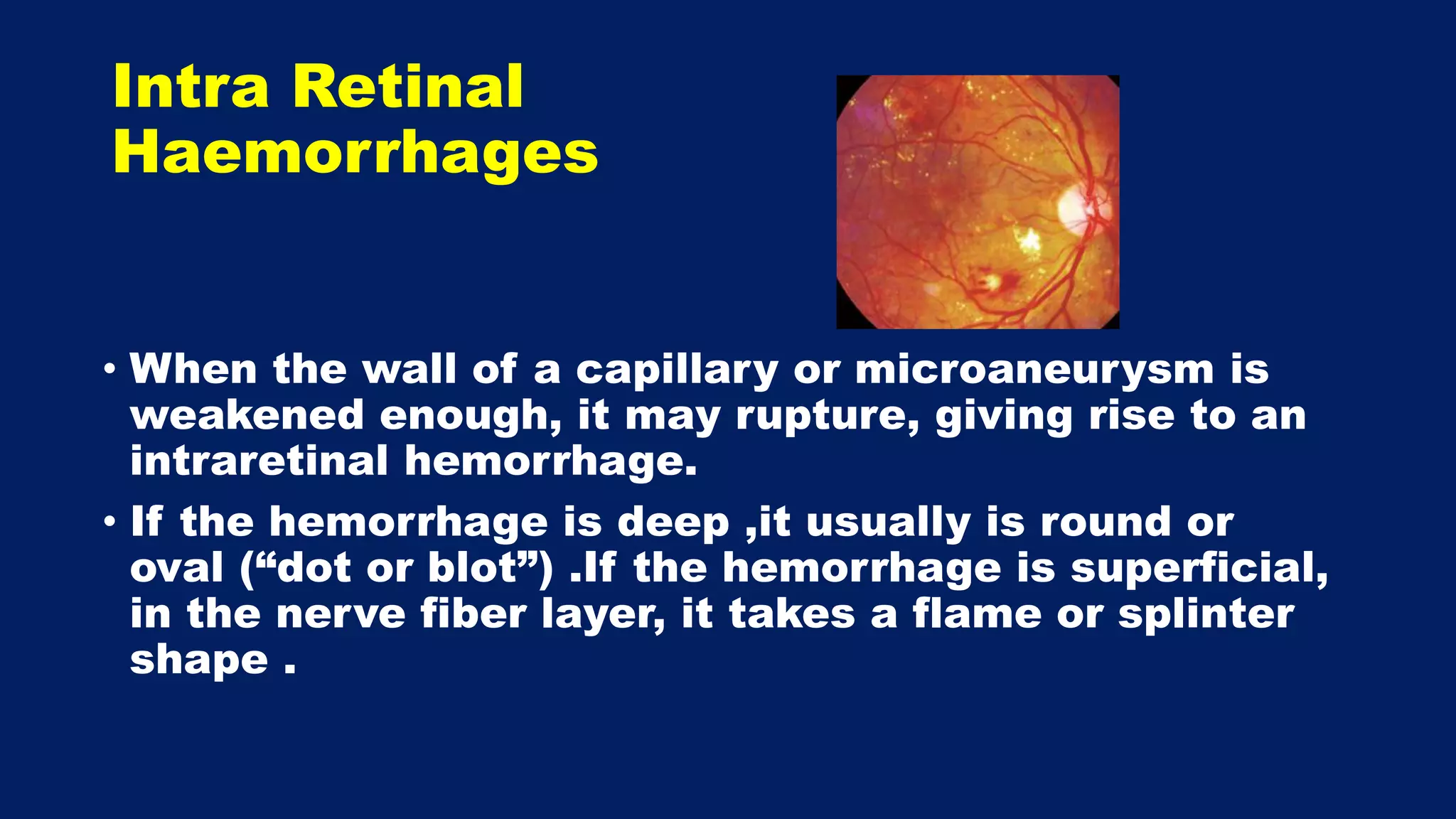 Diabetic retinopathy management | PPTX