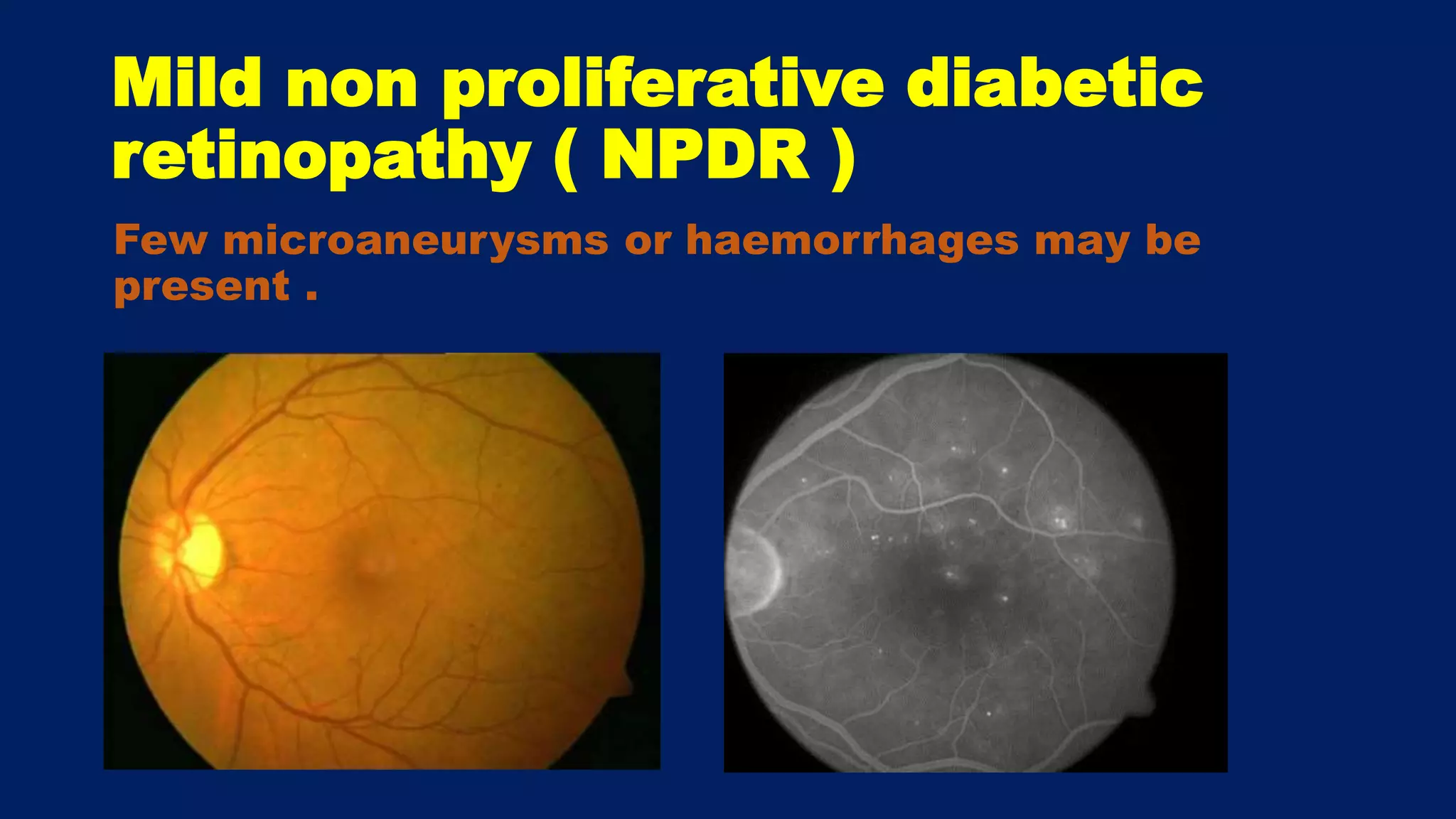 Diabetic retinopathy management | PPTX | Diabetes | Diseases and Conditions