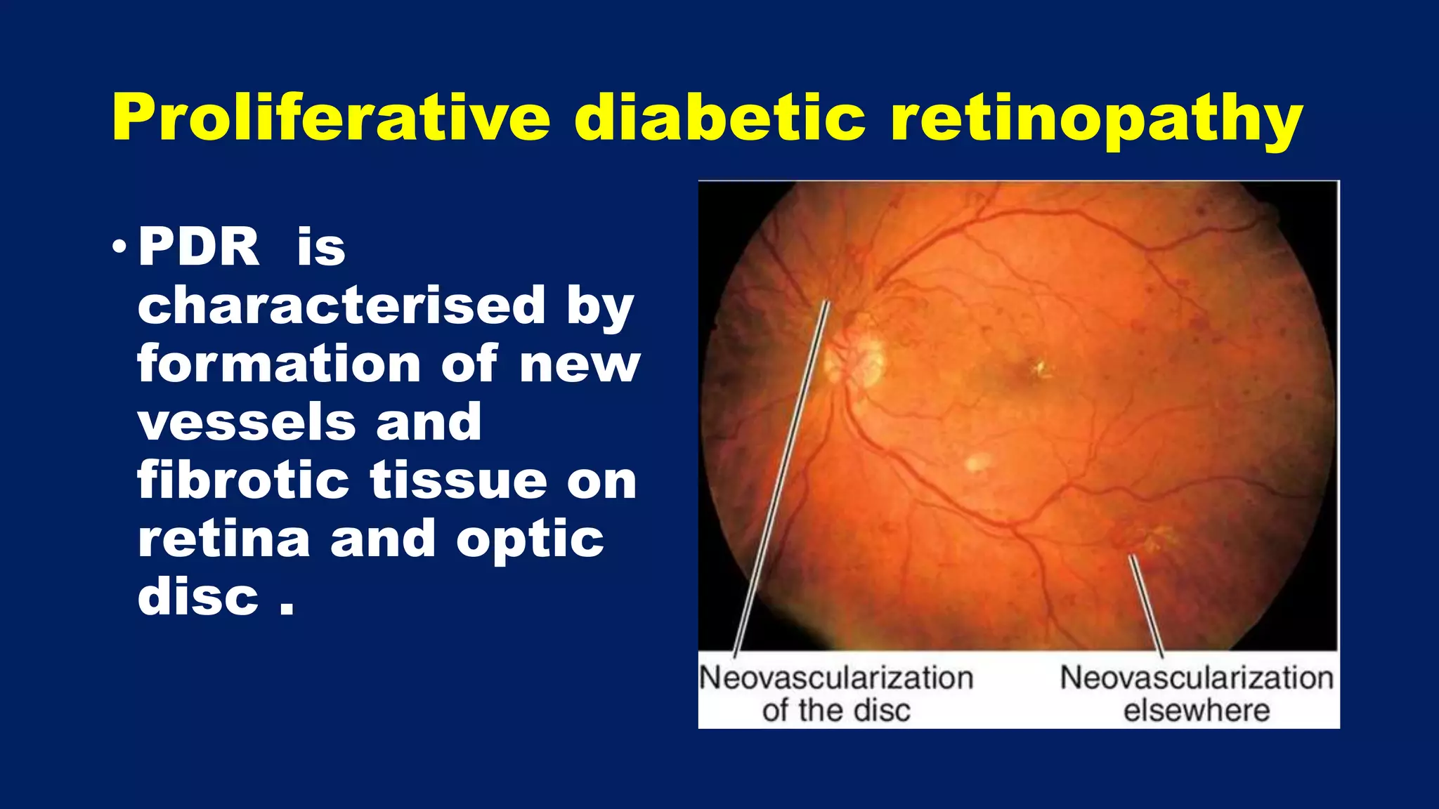 Diabetic retinopathy management | PPTX