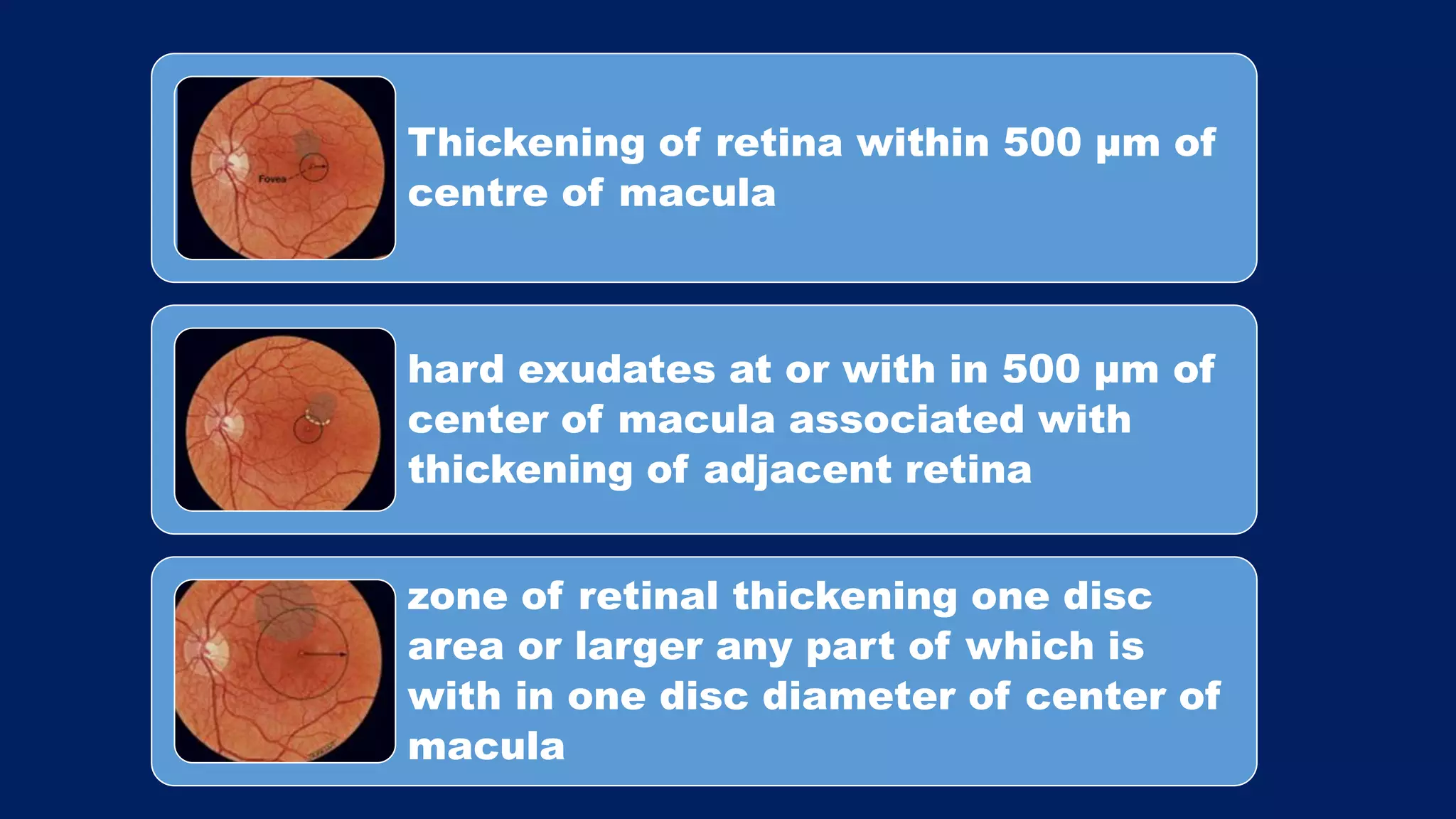 Diabetic retinopathy management | PPTX