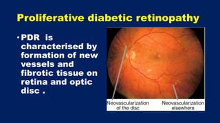 Diabetic retinopathy management | PPTX