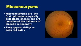 Diabetic retinopathy management | PPTX