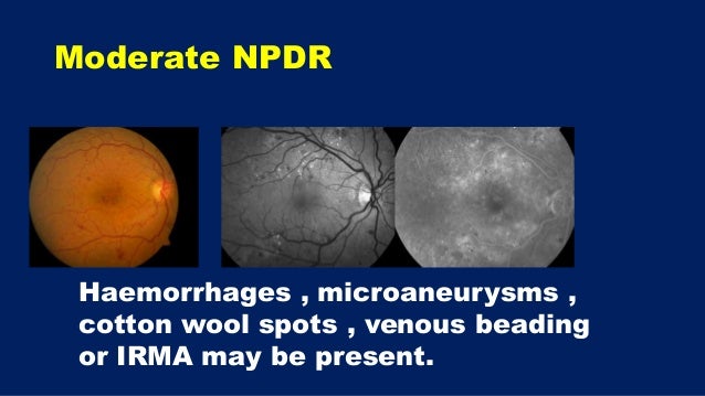 Diabetic retinopathy management