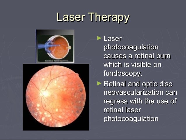 Diabetic retinopathy for medical student