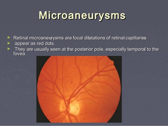 Diabetic retinopathy for medical student