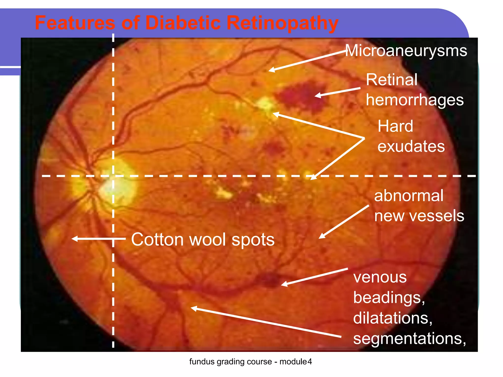 diabetic retinopathy present.pptx