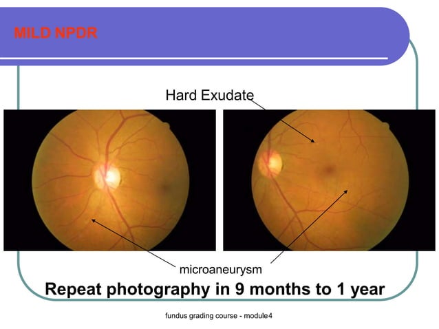 diabetic retinopathy present.pptx