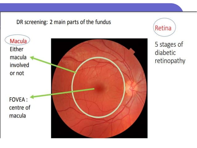 diabetic retinopathy present.pptx