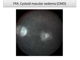 Diabetic retinopathy- Management | PPTX
