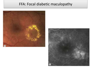 Diabetic retinopathy- Management | PPTX
