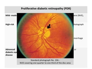 Diabetic retinopathy- Management | PPTX