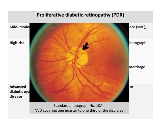 Diabetic retinopathy- Management | PPTX