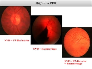 Diabetic retinopathy- Management | PPTX