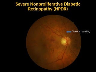 diabetic retinopatthy.pptx macular edema risk factor, management | PPTX
