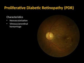 diabetic retinopatthy.pptx macular edema risk factor, management | PPTX