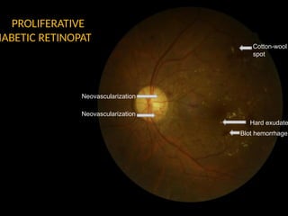 diabetic retinopatthy.pptx macular edema risk factor, management | PPTX