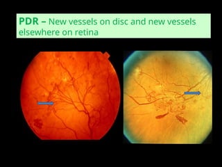 diabetic retinopatthy.pptx macular edema risk factor, management | PPTX