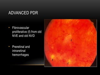 diabetic retinopatthy.pptx macular edema risk factor, management | PPTX