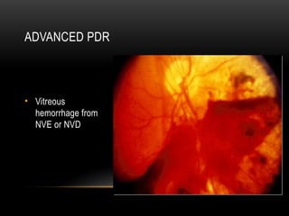 diabetic retinopatthy.pptx macular edema risk factor, management | PPTX