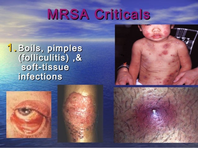 Diagnosis of mrsa by molecular methods