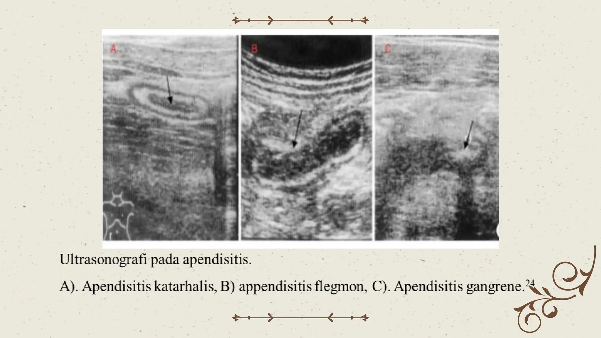 Diagnosa dan Tatalaksana Appendicitis Akut | PPTX