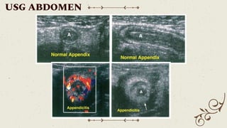 Diagnosa dan Tatalaksana Appendicitis Akut | PPTX