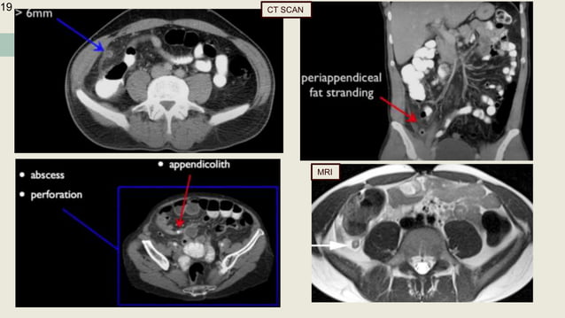 Diagnosa dan Tatalaksana Appendicitis Akut | PPTX