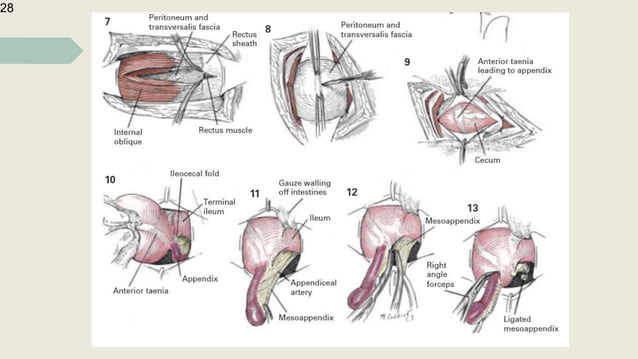 Diagnosa dan Tatalaksana Appendicitis Akut | PPTX
