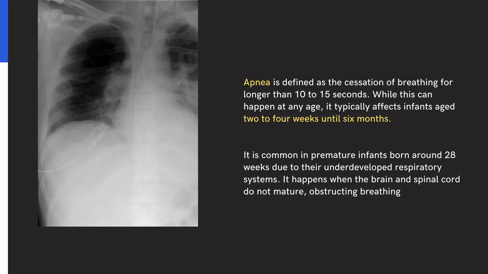 Neonatal Apnea | PDF