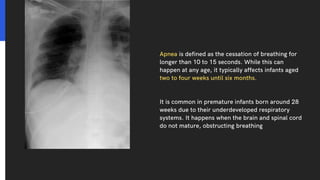Neonatal Apnea | PDF