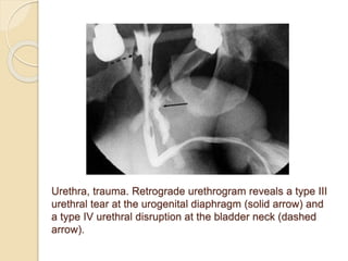 Dx & Mx of urethral and bladder injuries | PPTX | Death, Injury, or ...