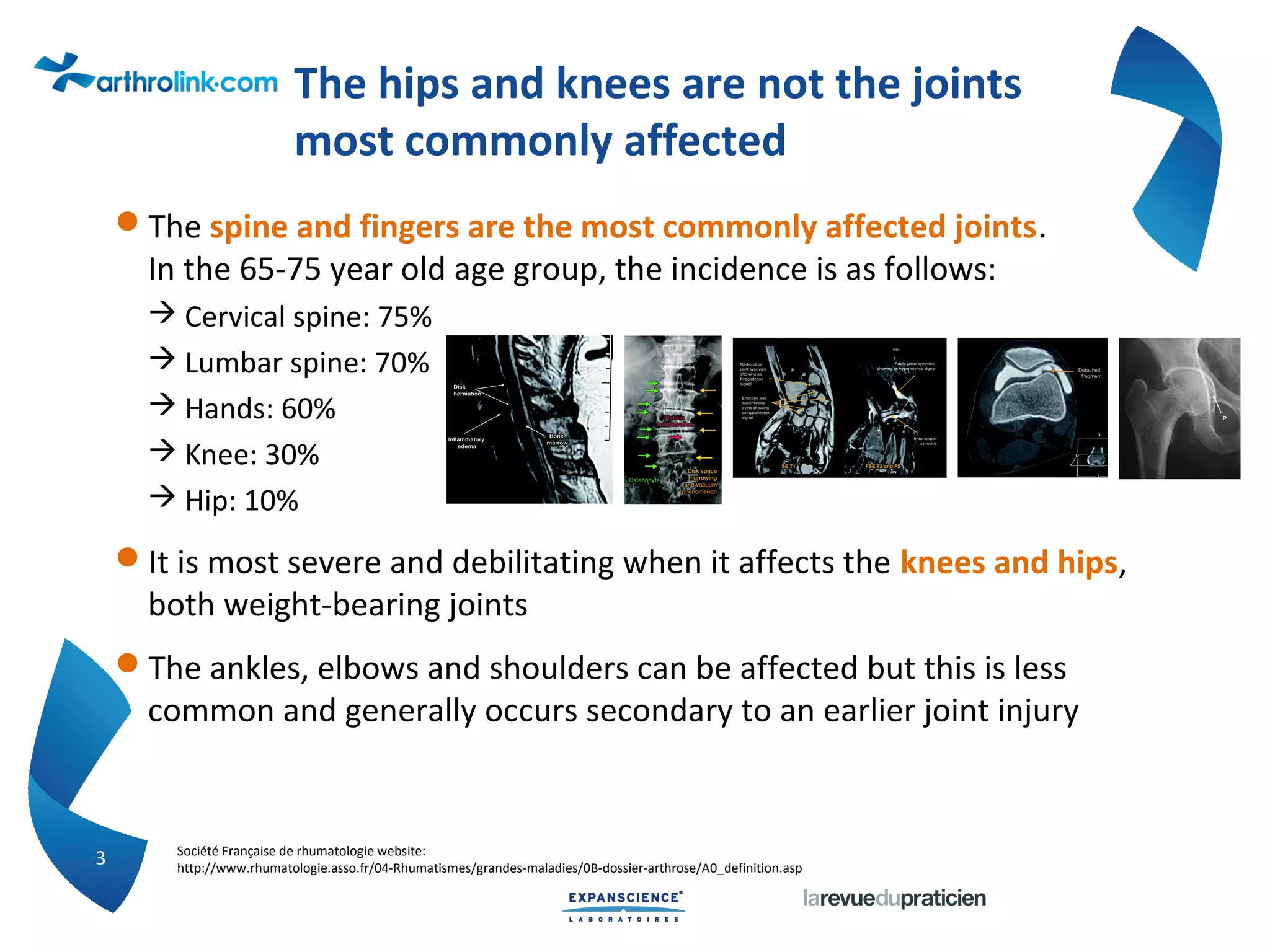 Diagnosing osteoarthritis | PPT