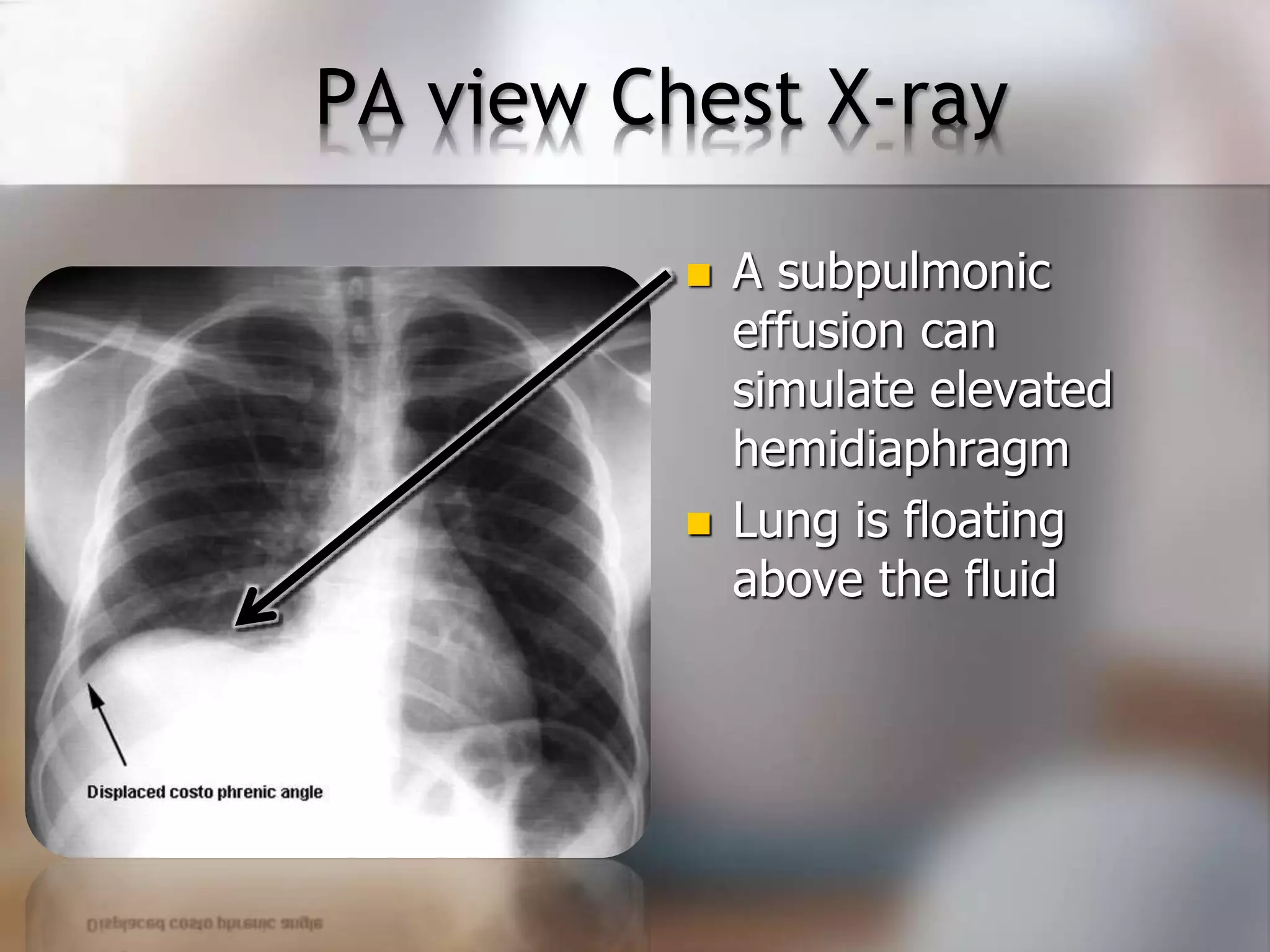 Diagnosing pleural effusion | PPTX
