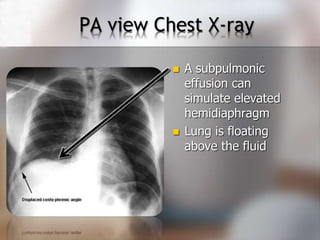 Diagnosing pleural effusion | PPTX