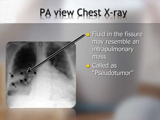 Diagnosing pleural effusion | PPTX