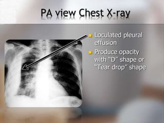 Diagnosing pleural effusion | PPTX
