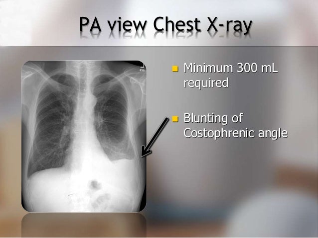 Diagnosing pleural effusion