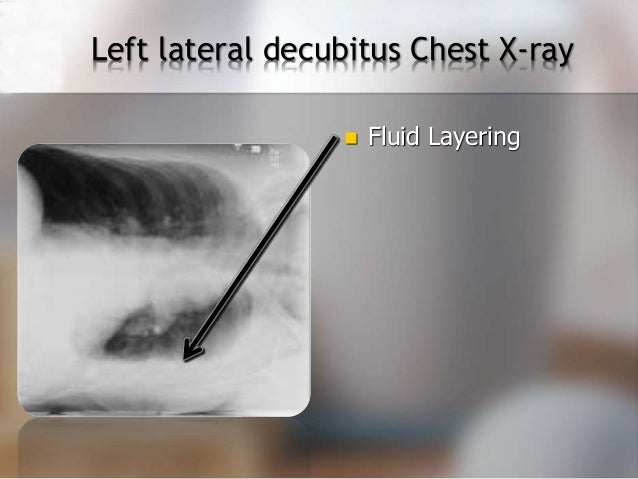 Chest X-Ray Lateral Decubitus View Procedure – JSHY
