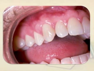 Exophytic lesion in the oral cavity | PPT