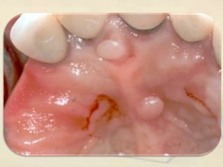 Exophytic lesion in the oral cavity | PPT