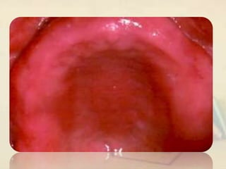 Exophytic lesion in the oral cavity | PPT
