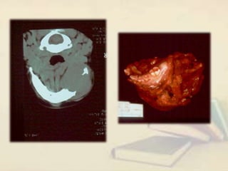 Exophytic lesion in the oral cavity | PPT