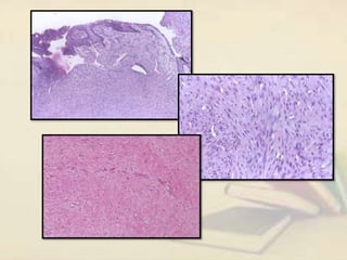 Exophytic lesion in the oral cavity | PPT