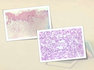 Exophytic lesion in the oral cavity | PPT